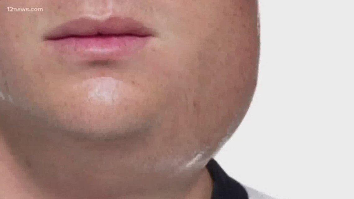 Several LSU students have mumps; here is what you need to know about ...