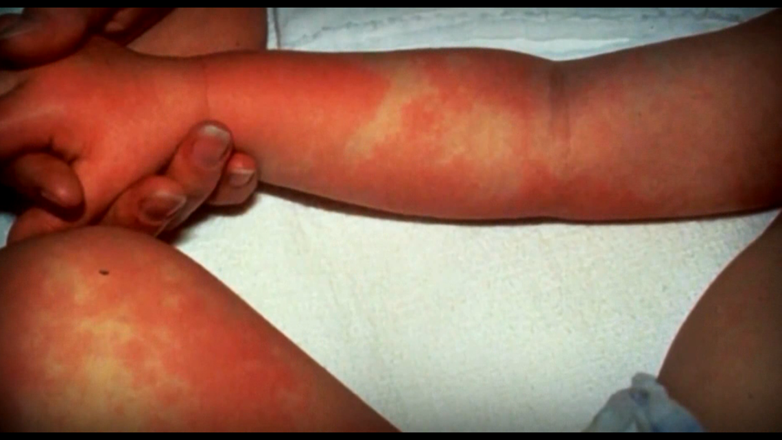 Louisiana child dies from MIS-C, condition linked to COVID-19 | wwltv.com