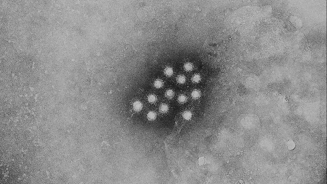 Louisiana faces Hepatitis A outbreak; Here's what you need to know ...