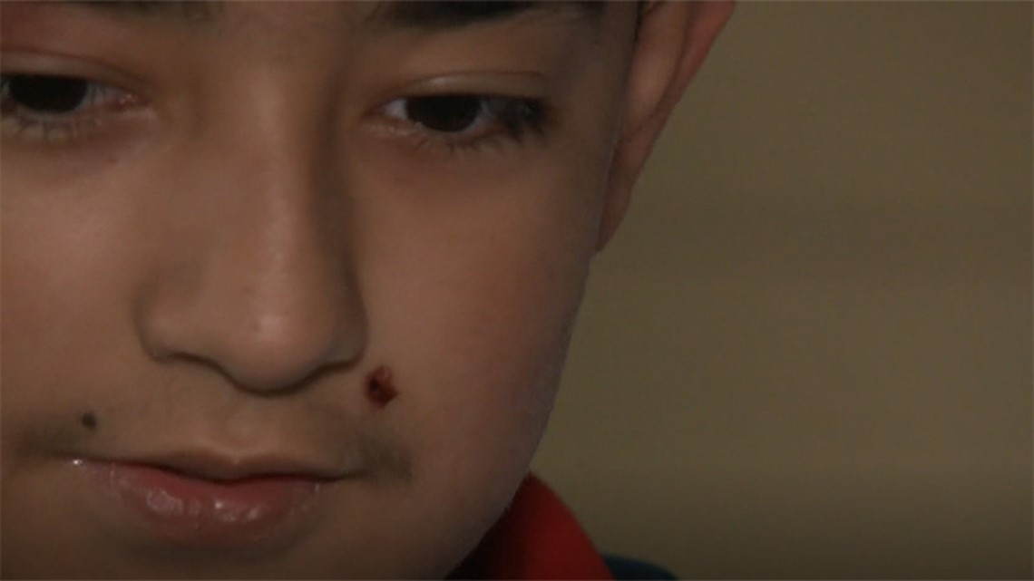 Boy survives falling bullet that went through face on New Year's Eve ...