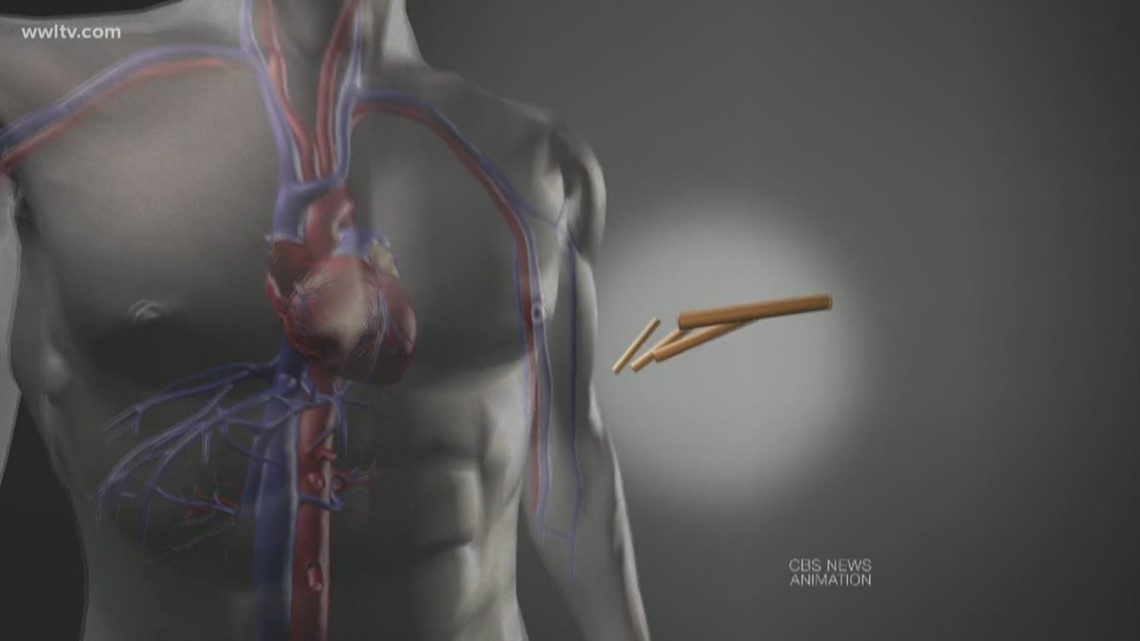 Northshore man battling addiction gets new implant to end his cravings ...