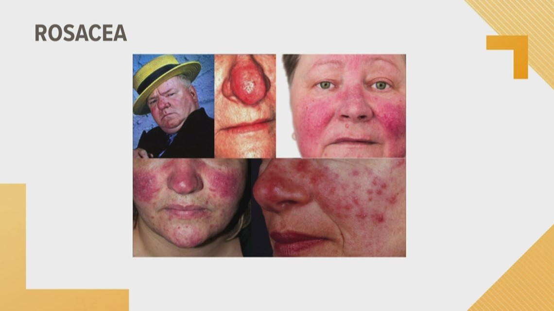 Alcohol Aggravates Common Skin Conditions | wwltv.com